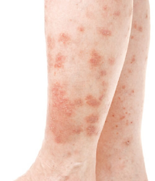 Saiba o que é dermatite atópica - Melhor com saúde