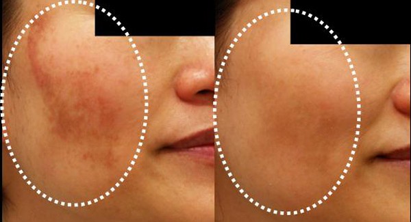 Tratar o melasma: veja como fazer um tratamento natural