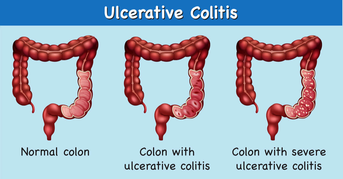 Para a colite ulcerativa: tratamentos caseiros - Melhor com Saúde