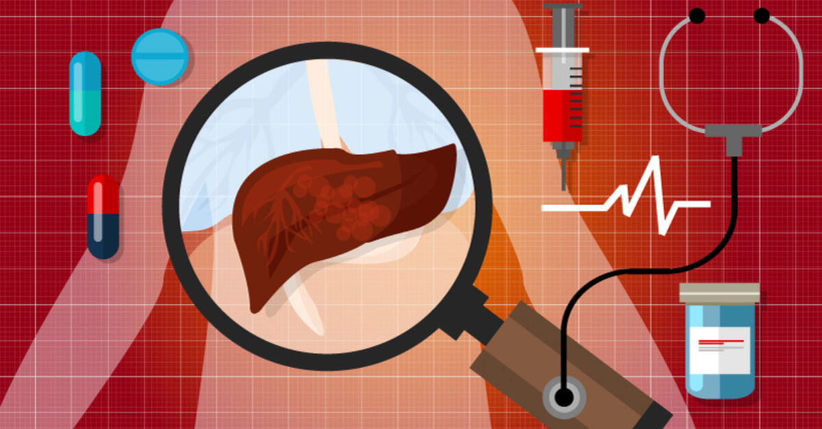 Como saber se seu fígado está inflamado? - Melhor com Saúde