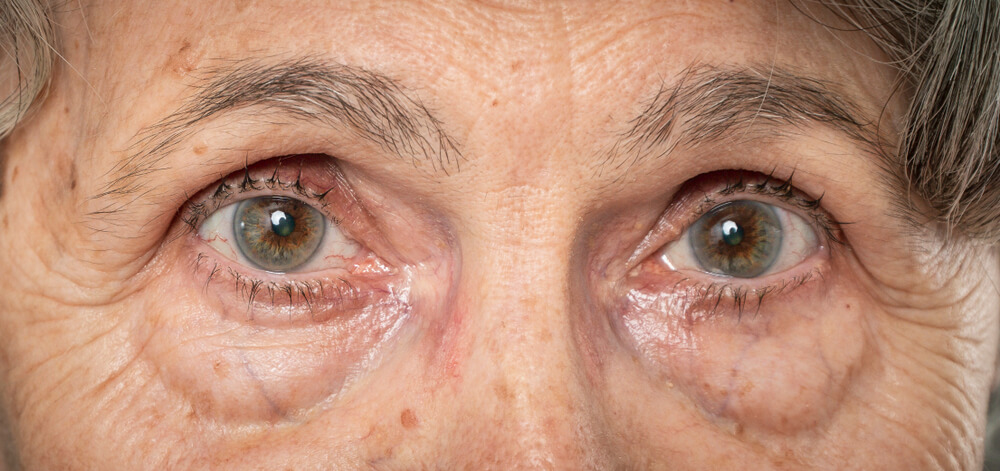 5 remédios naturais para deter a degeneração macular