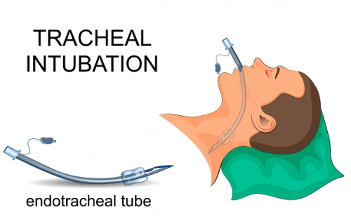 O uso de tubos endotraqueais - Melhor Com Saúde