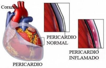 Pericardite: sintomas, causas e tratamento - Melhor com Saúde