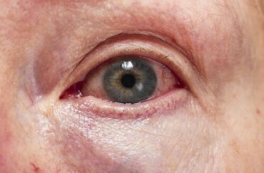 Tratamento da uveíte: tudo que você precisa saber
