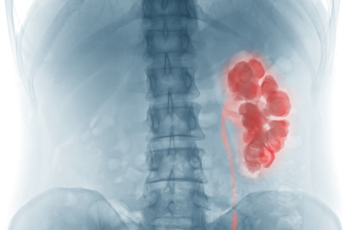 O que é a hidronefrose e qual é o seu tratamento?